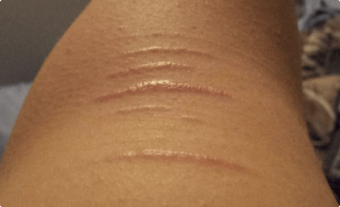 Linear Scar Lines - The Scar Clinic Perth